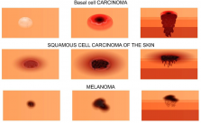 What Are Skin Cancers of the Feet? | Hamilton Foot Care